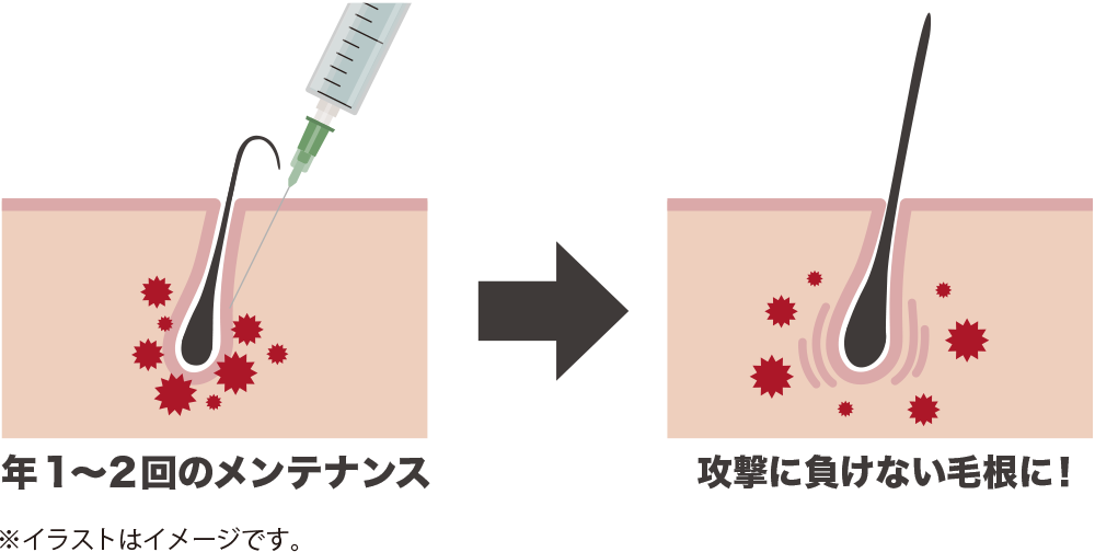 HARG療法とは？生える理由や治療方法の特徴を解説 | 四谷ローズクリニック