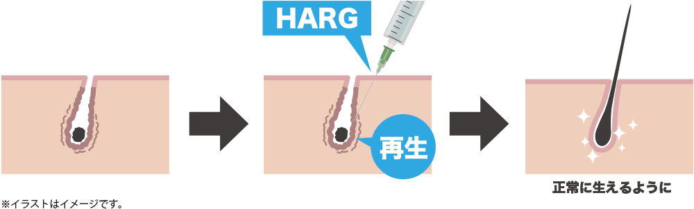 HARG療法とは？生える理由や治療方法の特徴を解説 | 四谷ローズクリニック